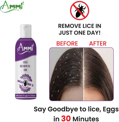 Ammi 100% Natural | Kills Lice, Eggs & Nits | Easy & Safe for Kids Hair ...