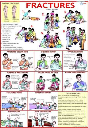 First Aid chart - Fractures Photographic Paper - Educational posters in ...