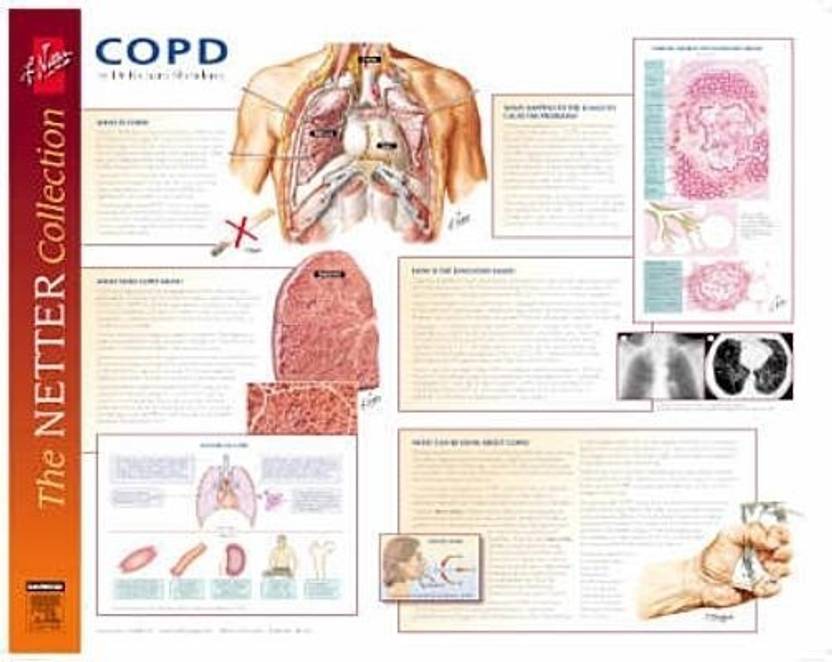 Frank H. Netter Chronic Obstructive Pulmonary Disease Poster: Buy Frank ...