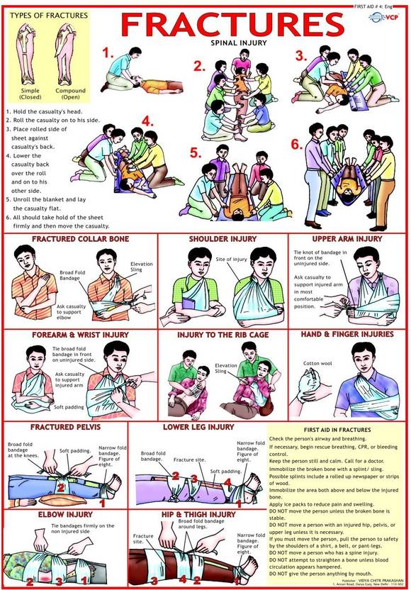 First Aid chart - Fractures Photographic Paper - Educational posters in ...