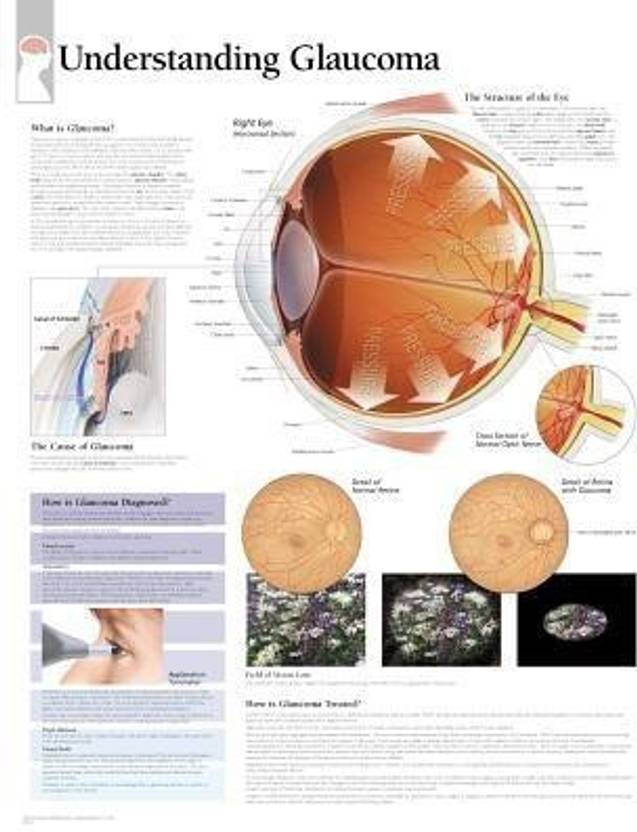 Understanding Glaucoma Laminated Poster: Buy Understanding Glaucoma ...