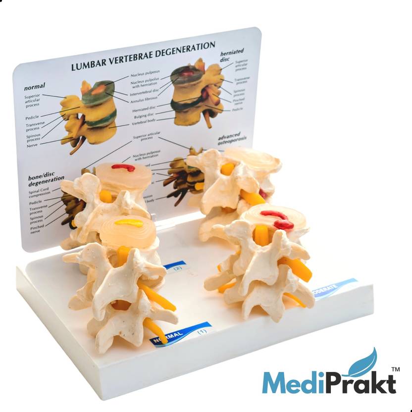MediPrakt | VERTEBRAE DEGENERATION MODEL | 4 STAGE DISC DEGENERATION ...