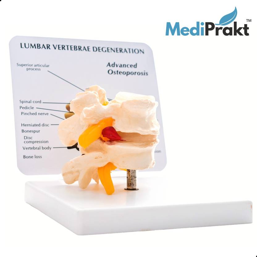 MediPrakt | VERTEBRAE DEGENERATION MODEL | Advanced STAGE DISC ...