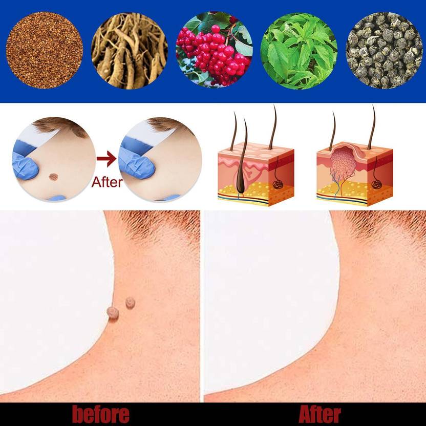 BNF 20G Wart Treatment Cream Skin Tag Removal Plaster Warts Remover For ...
