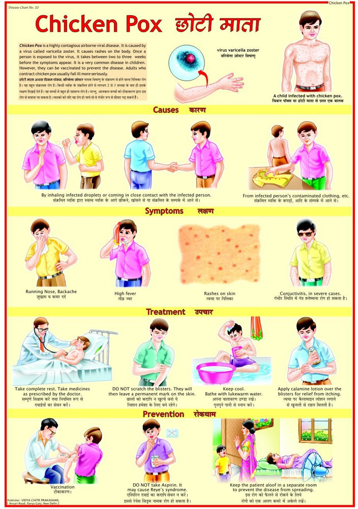 Prevention Of Chickenpox